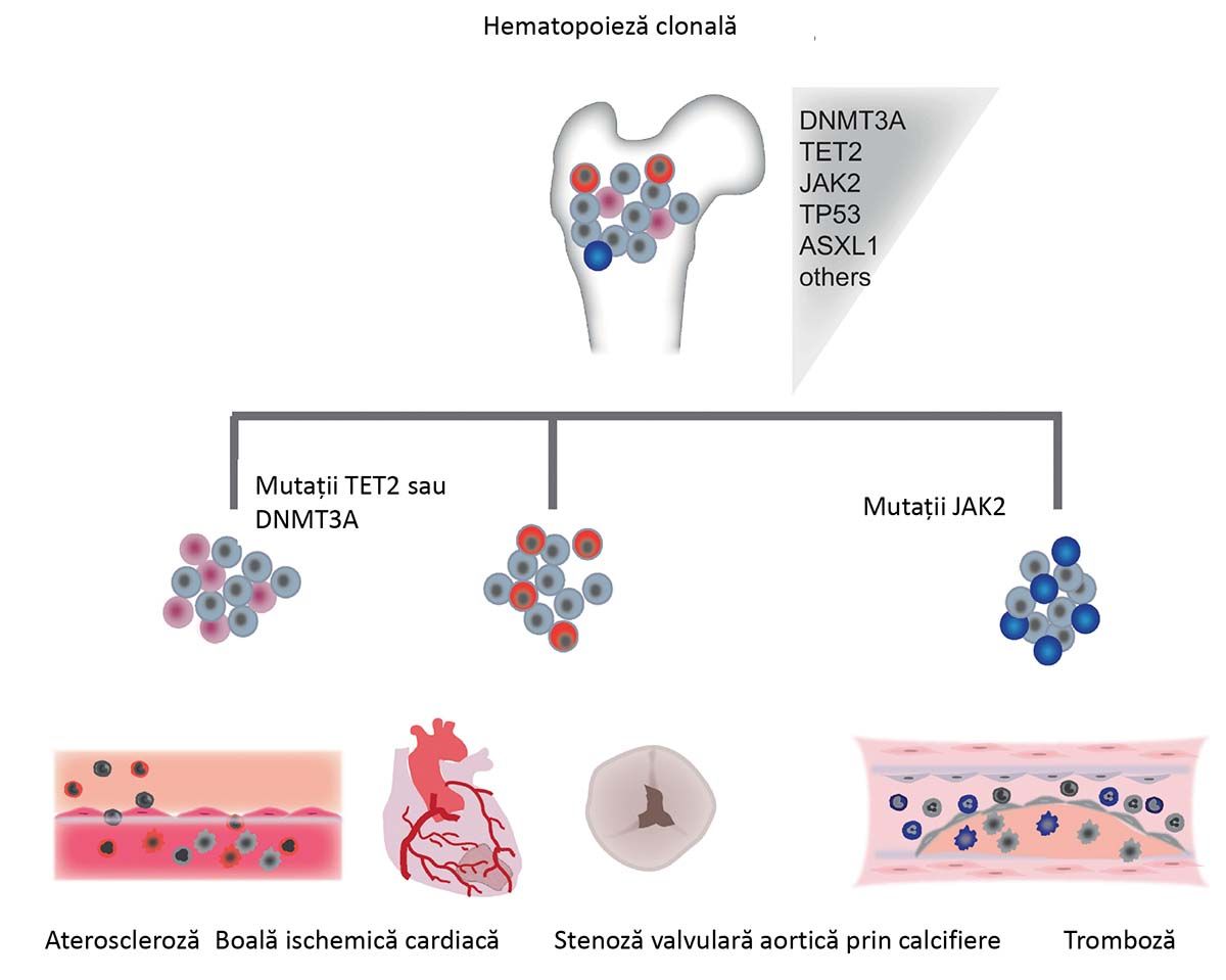 Hematopoieza clonală (2) - Viața Medicală
