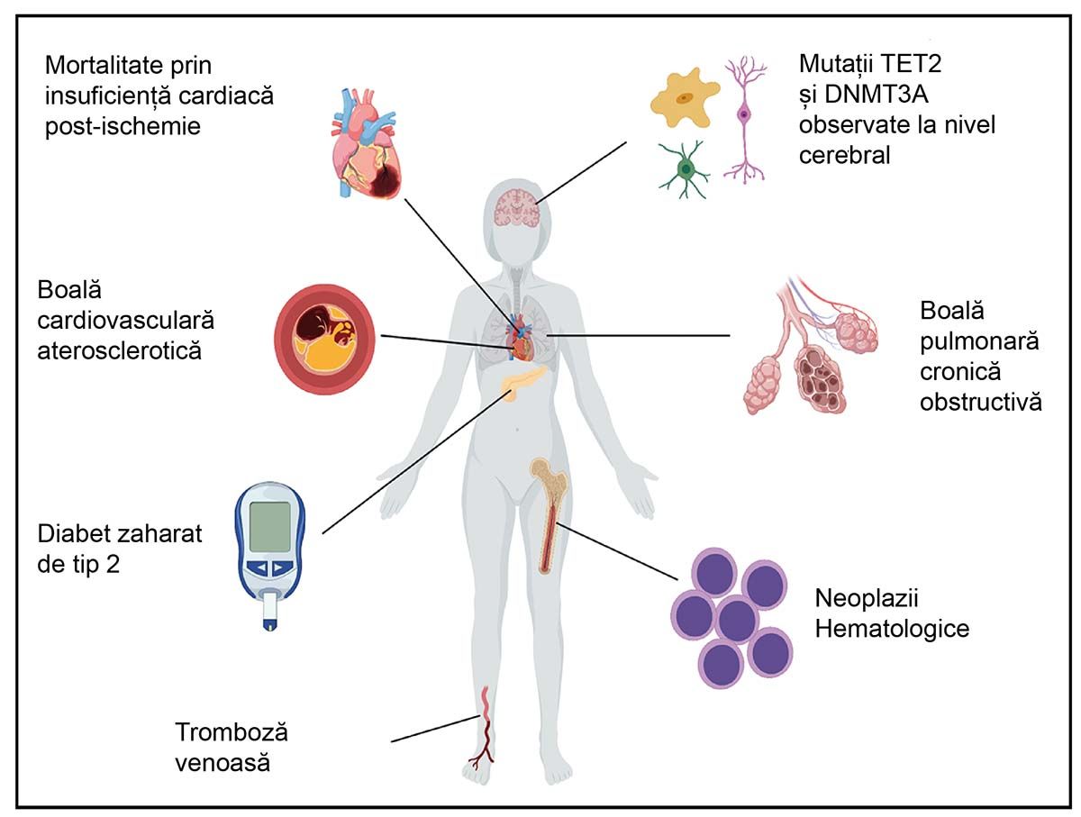 Hematopoieza clonală (2) - Viața Medicală
